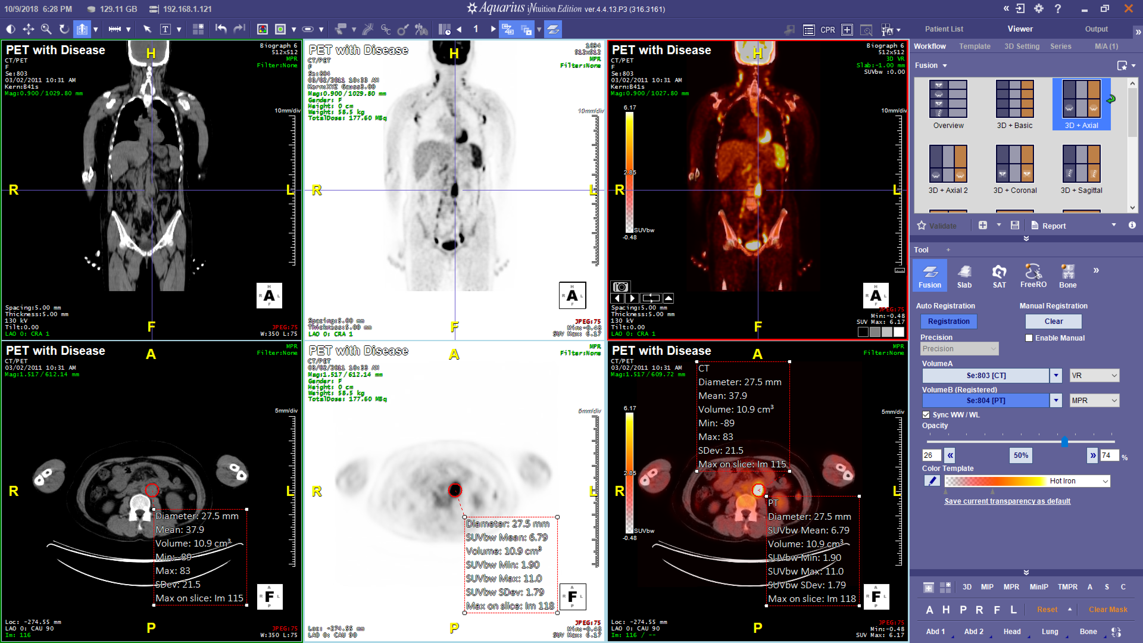 Body Fusion Package | TeraRecon